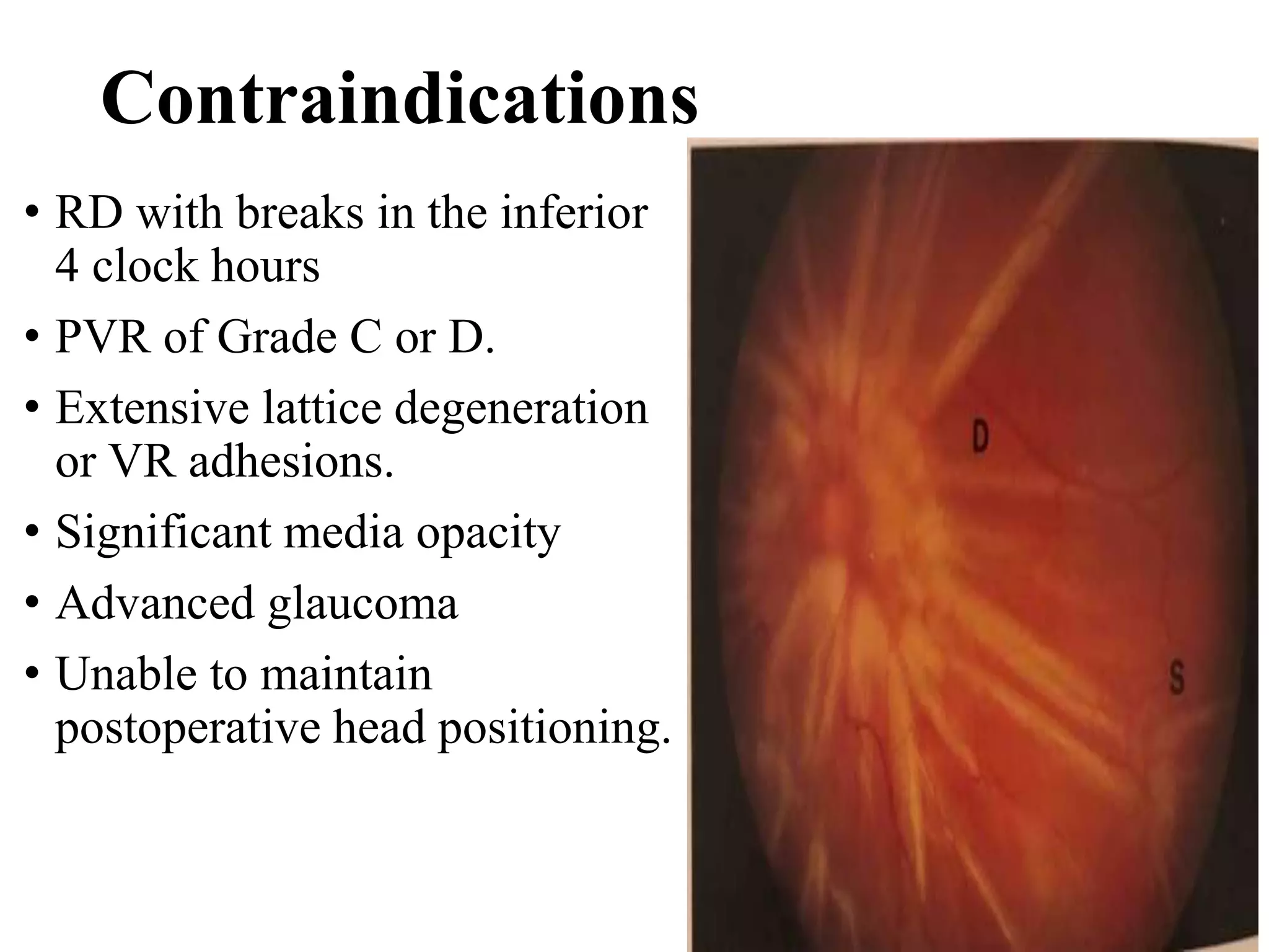 Principles And Technique Of Pneumatic Retinopexy Dr Avuru C J Pptx