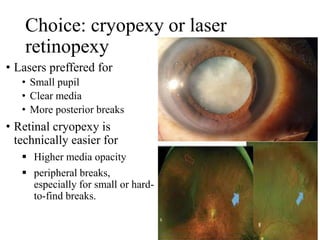 Principles and technique of pneumatic retinopexy (Dr. Avuru C.J).pptx