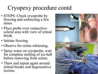 Principles and technique of pneumatic retinopexy (Dr. Avuru C.J).pptx