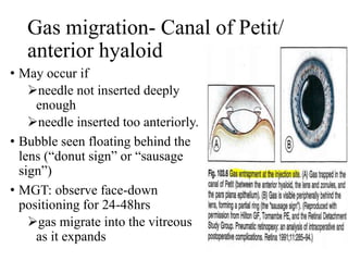 Principles and technique of pneumatic retinopexy (Dr. Avuru C.J).pptx