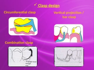 Principles & Designing of Removable partial denture.pptx