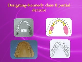 Principles & Designing of Removable partial denture.pptx