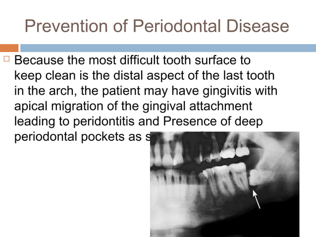 Principles, indications and contraindications of removal of | PPT ...