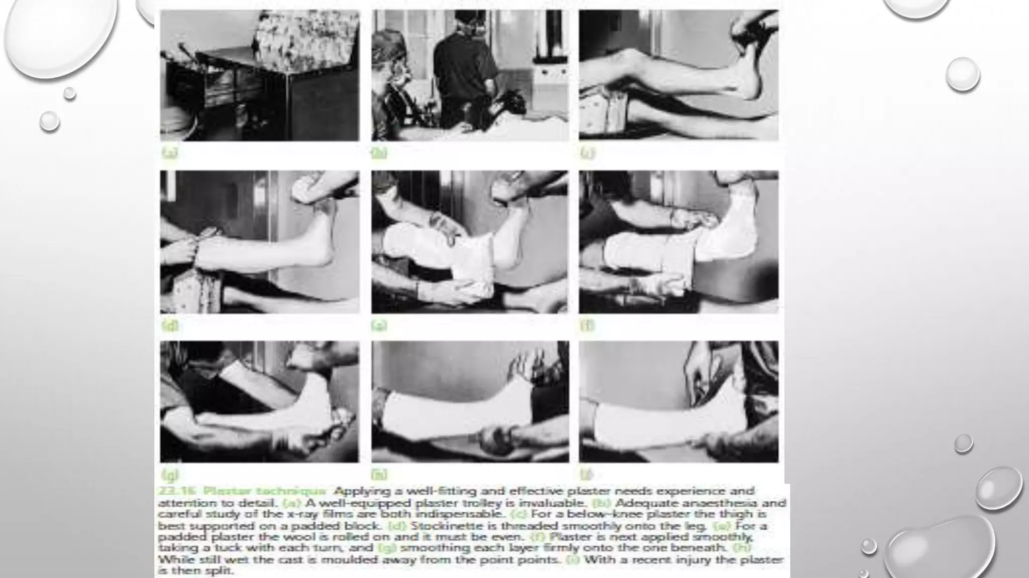 Principles in fractures management | PPTX