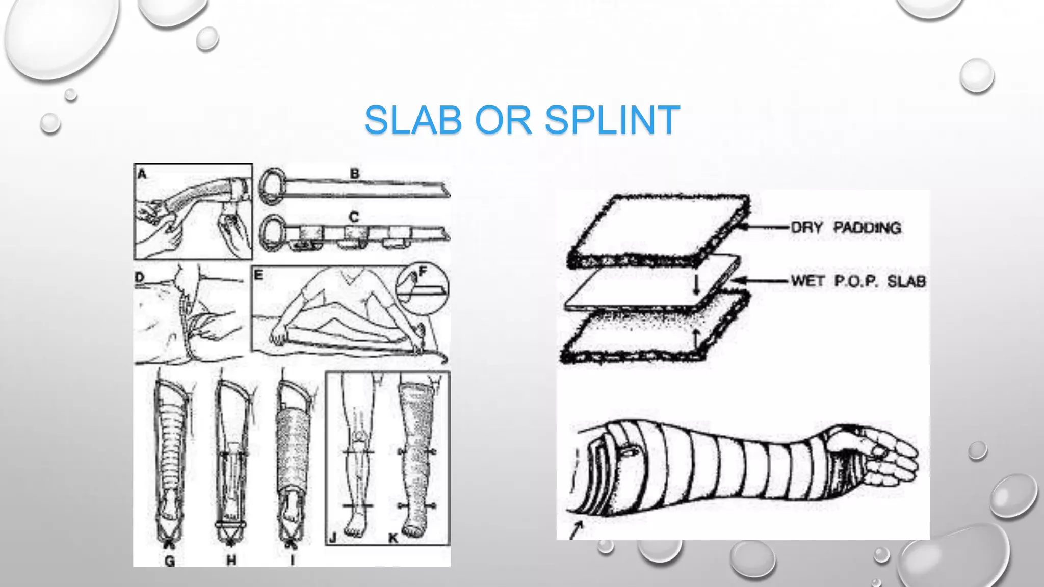 Principles in fractures management | PPTX