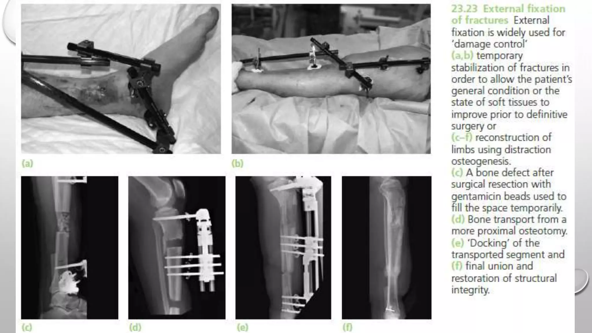 Principles in fractures management | PPTX