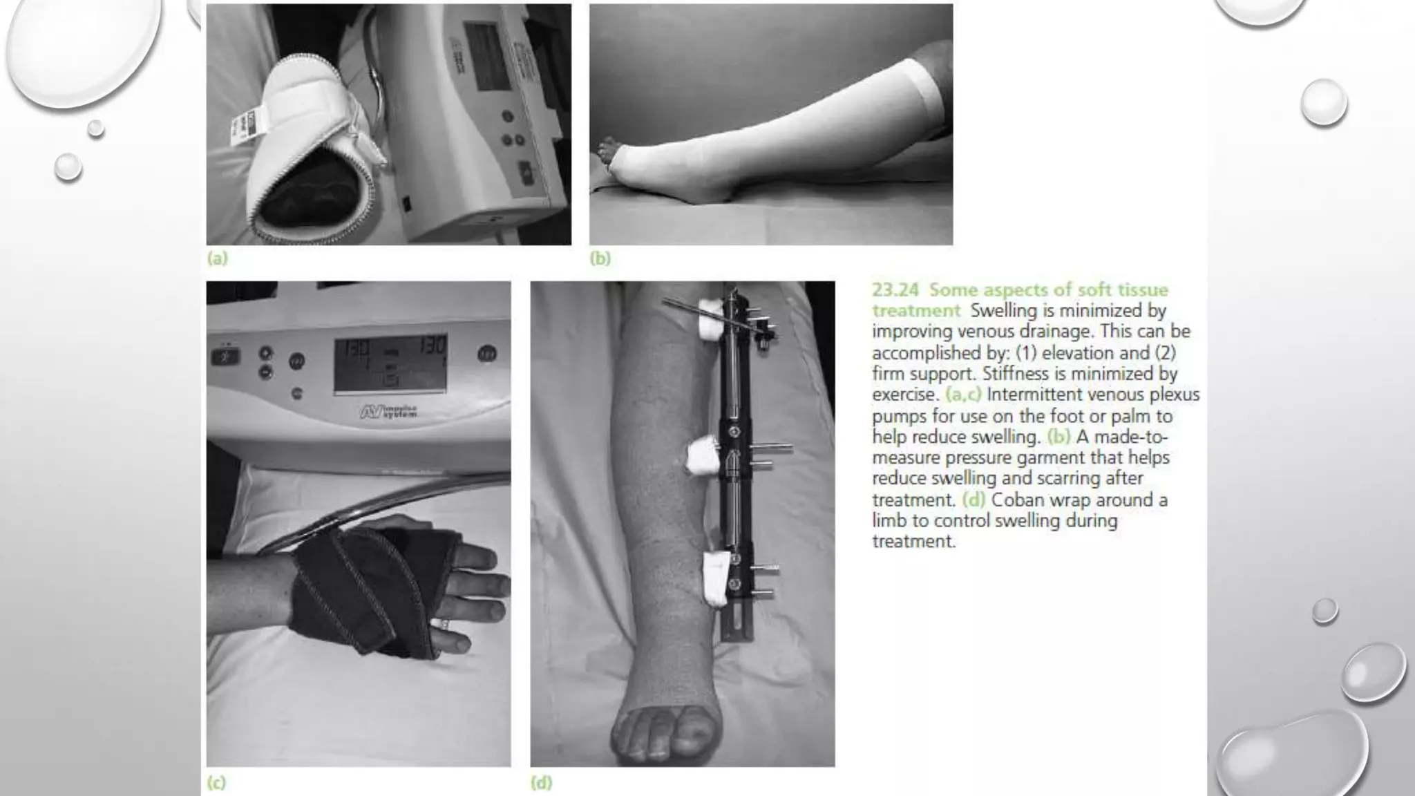 Principles in fractures management | PPTX