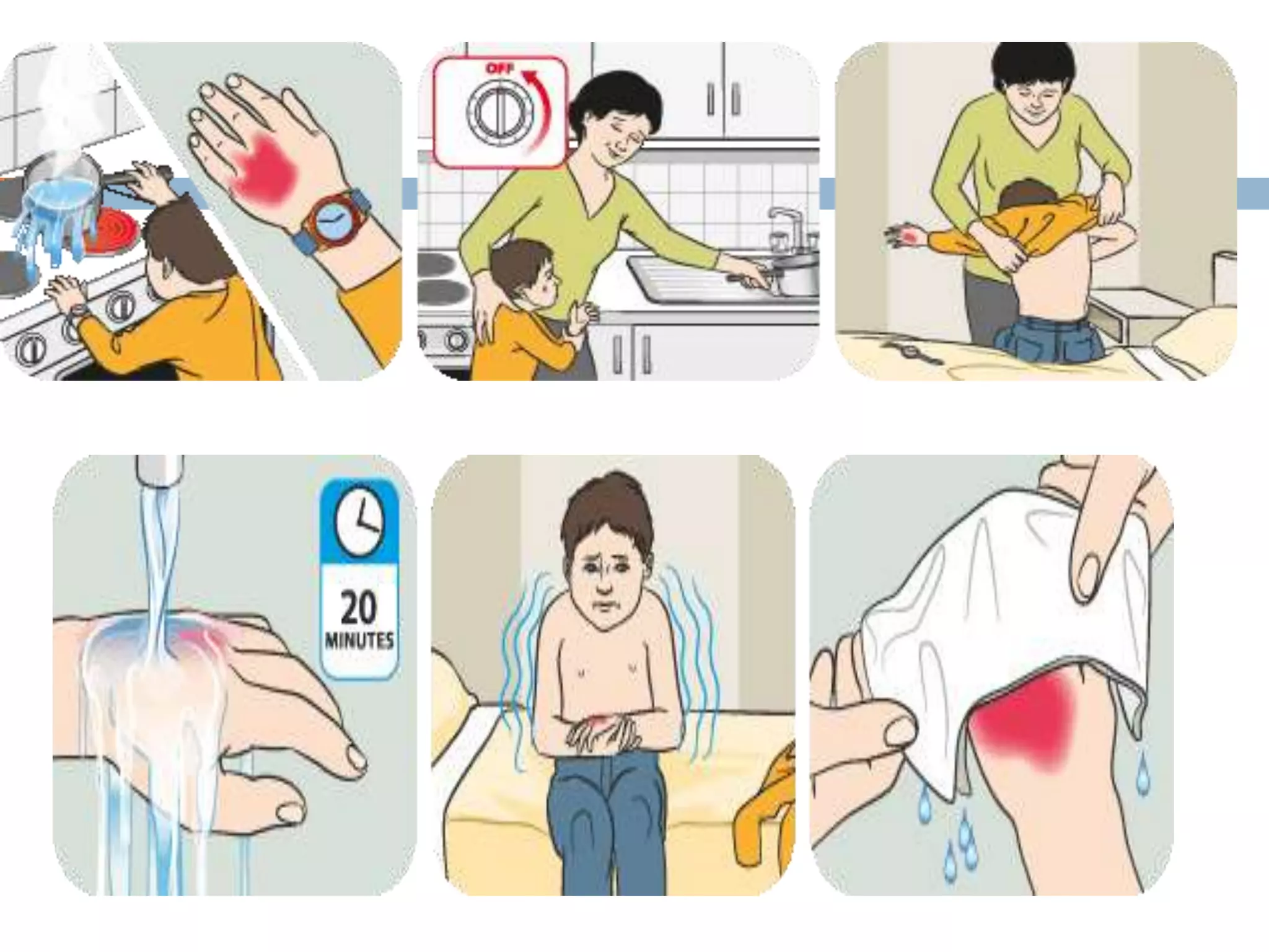 Principles in management of burns | PPTX