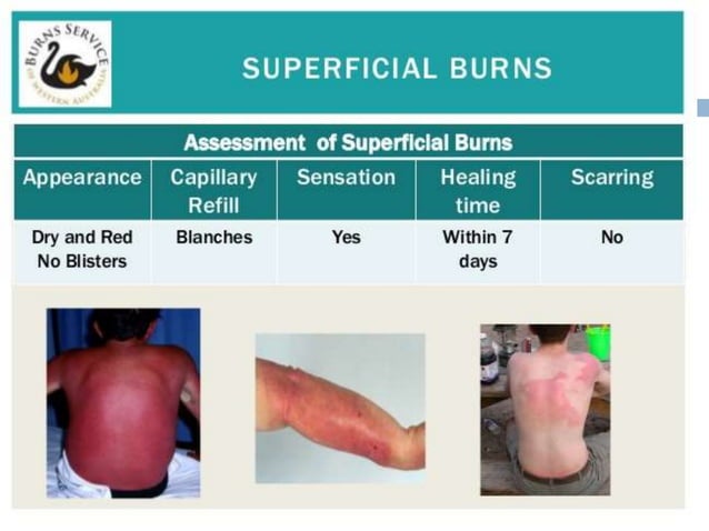 Principles in management of burns | PPT | Free Download