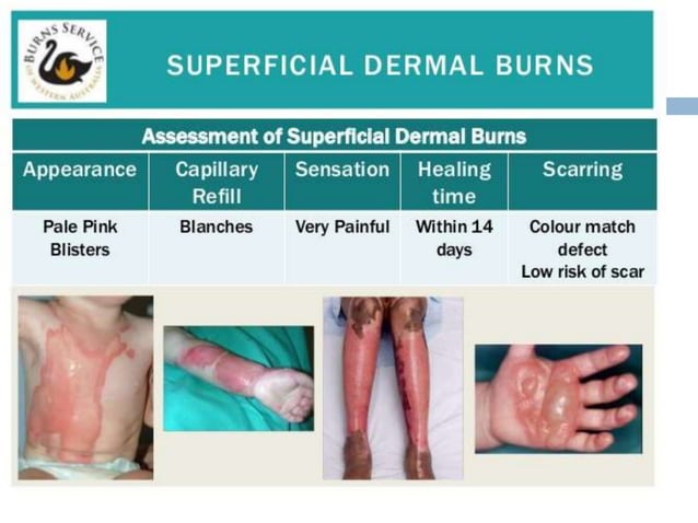 Principles in management of burns | PPT