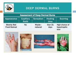 Principles in management of burns | PPTX
