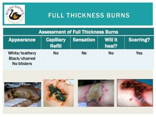 Principles in management of burns | PPTX