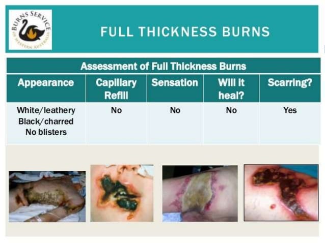 Principles in management of burns | PPT