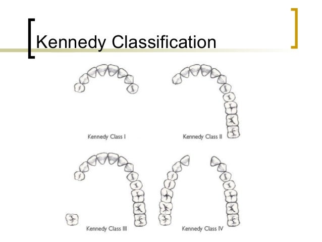 Principles in metallic rpd design ..... Video 1 : https://www.dropbo…