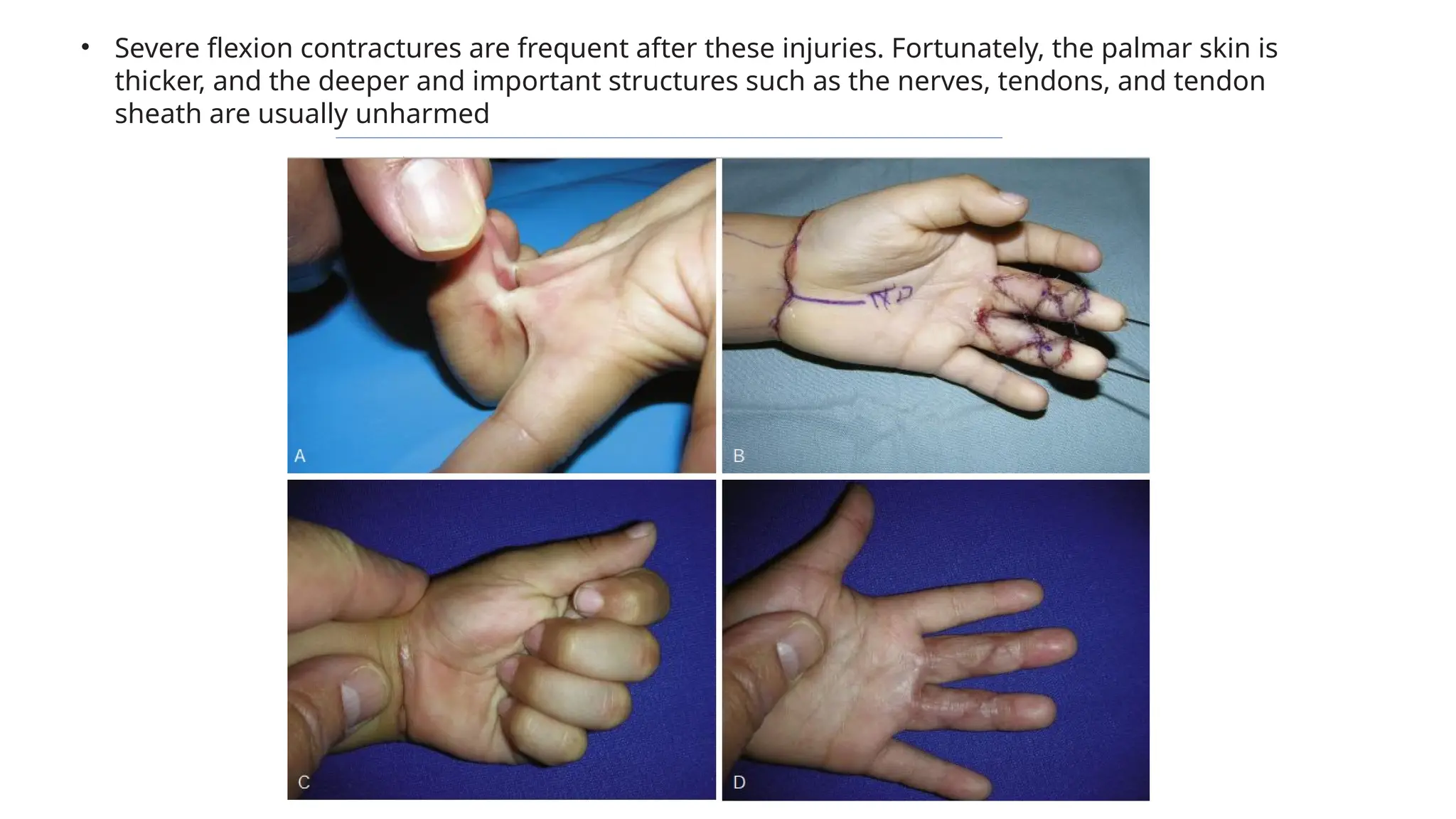 Principles of Acute Care of Hand injuries.pptx