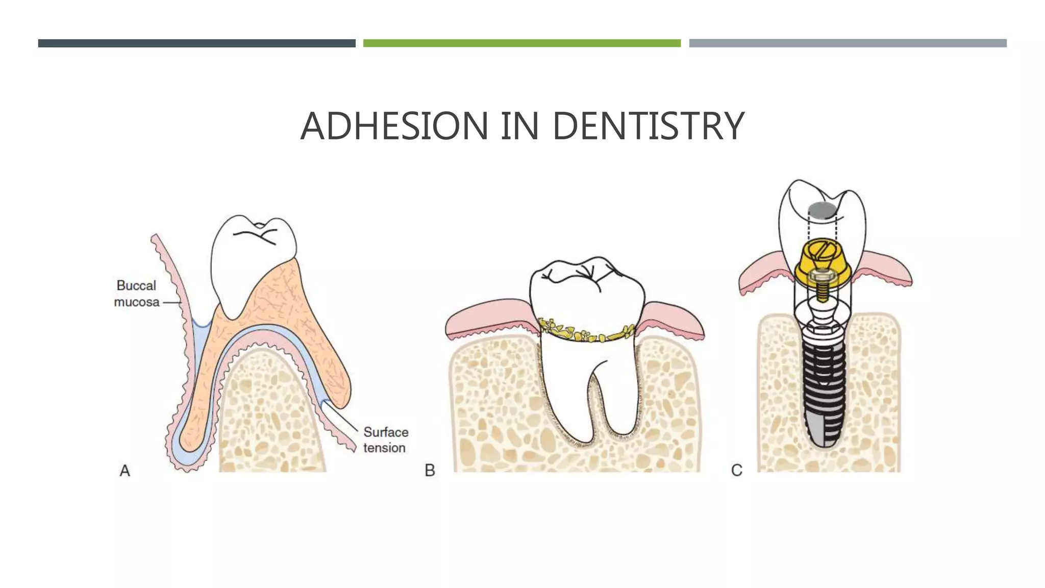 Principles of adhesion in dentistry | PPTX