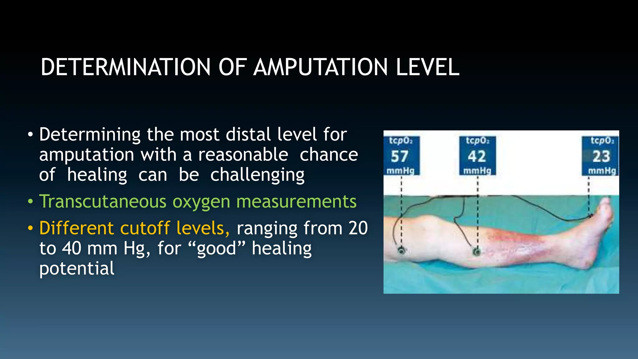 Principles of amputation | PPTX