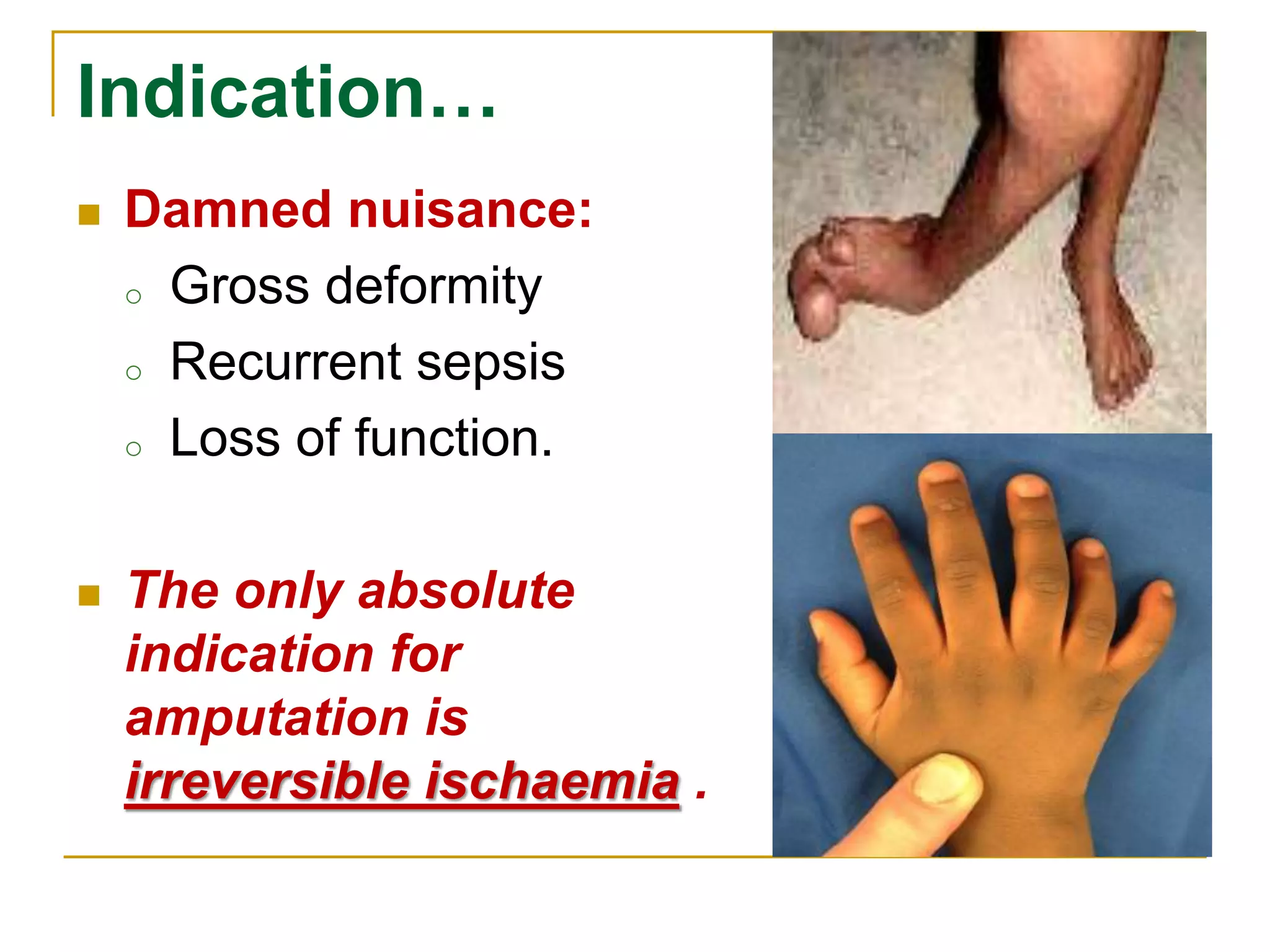 Principles of amputation | PPTX