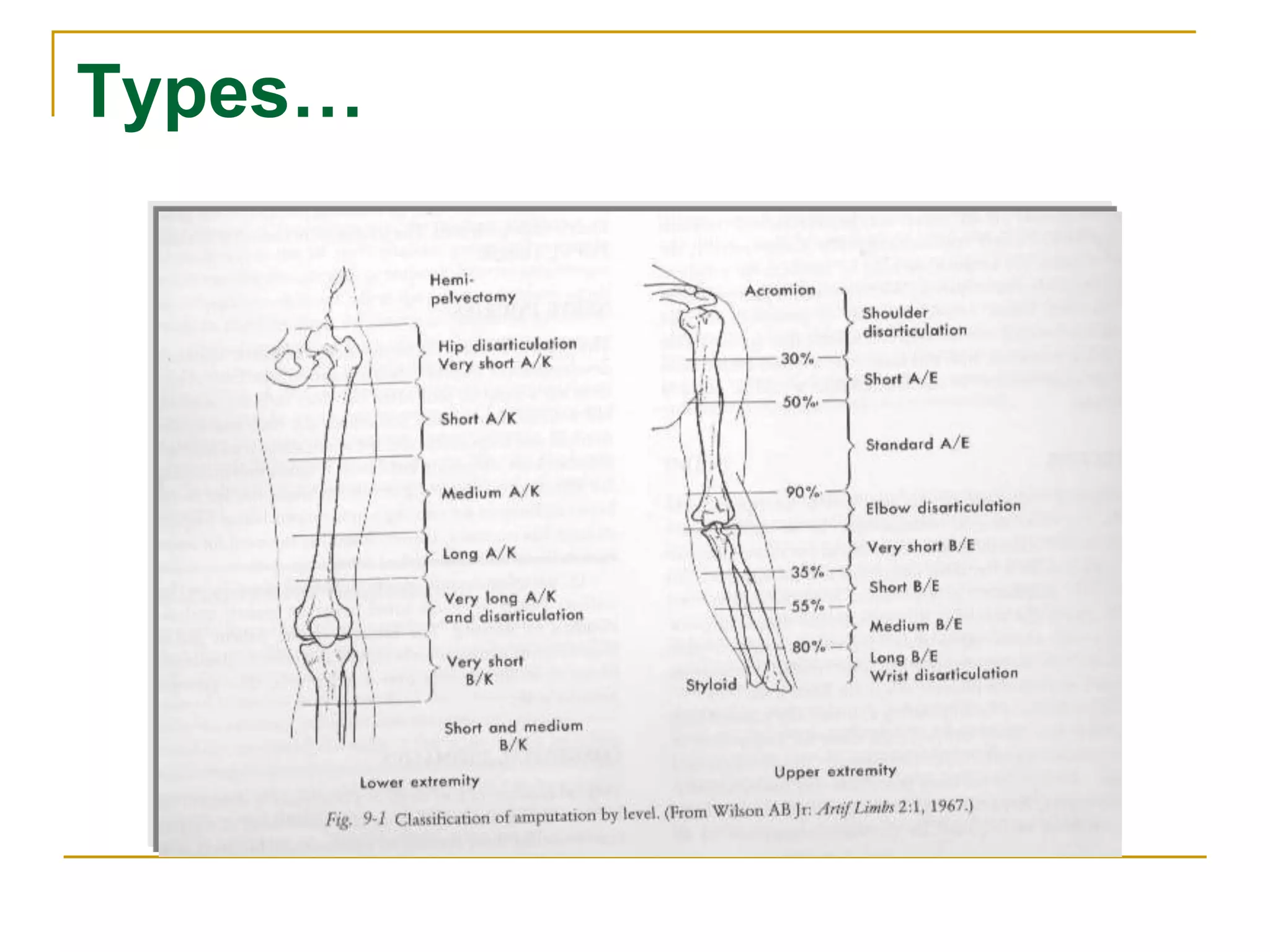 Principles of amputation | PPTX