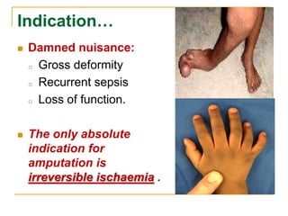 Principles of amputation | PPTX