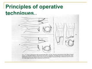 Principles of amputation | PPTX