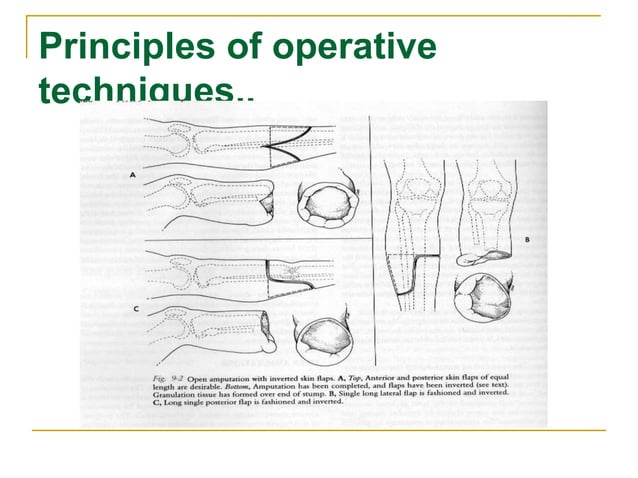 Principles of amputation | PPT