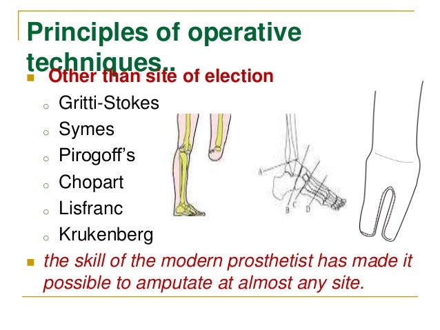 Principles of amputation