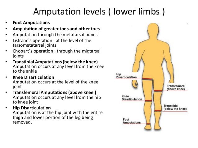Principles of amputation
