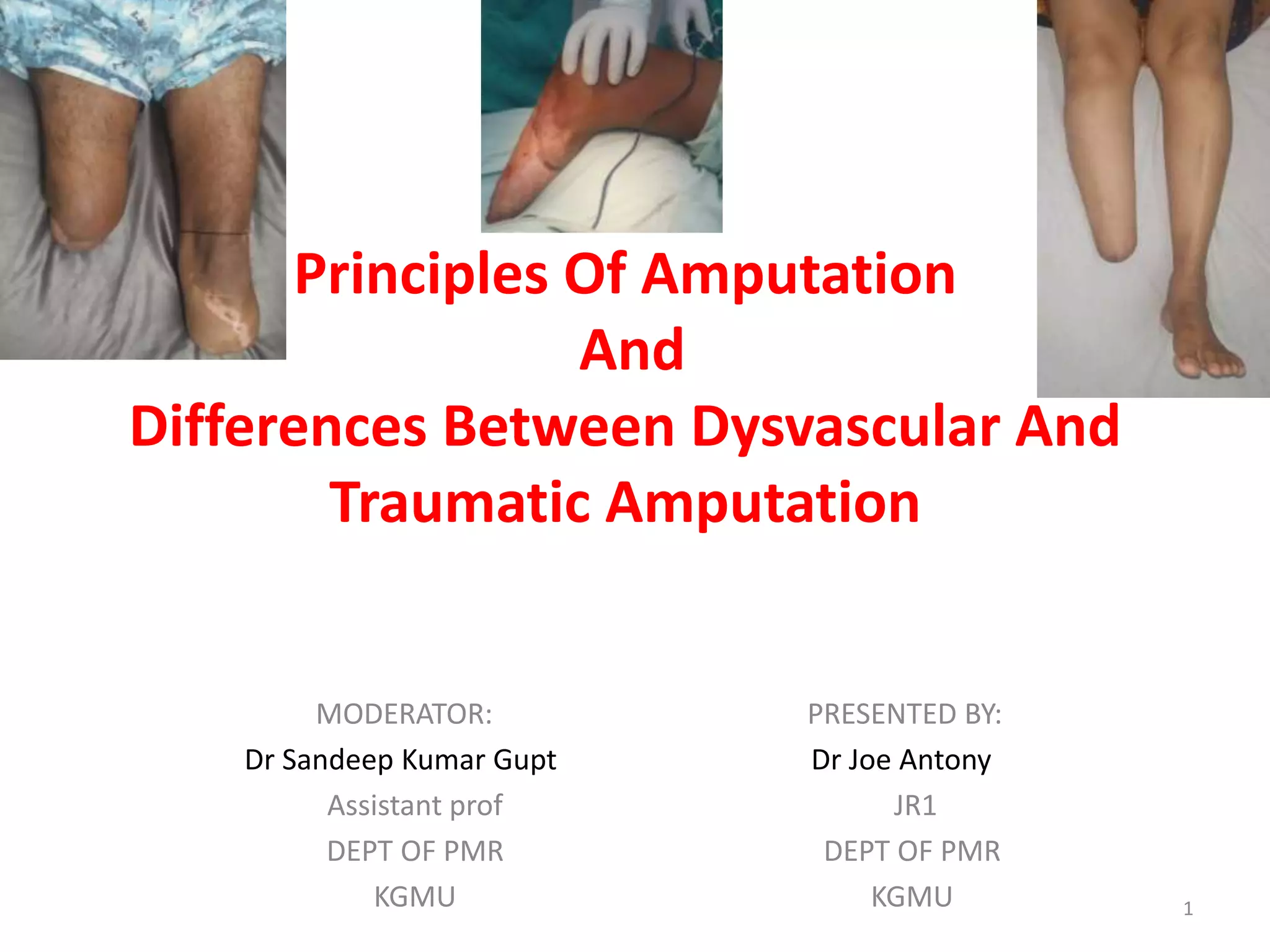 Principles Of Amputation | PPTX