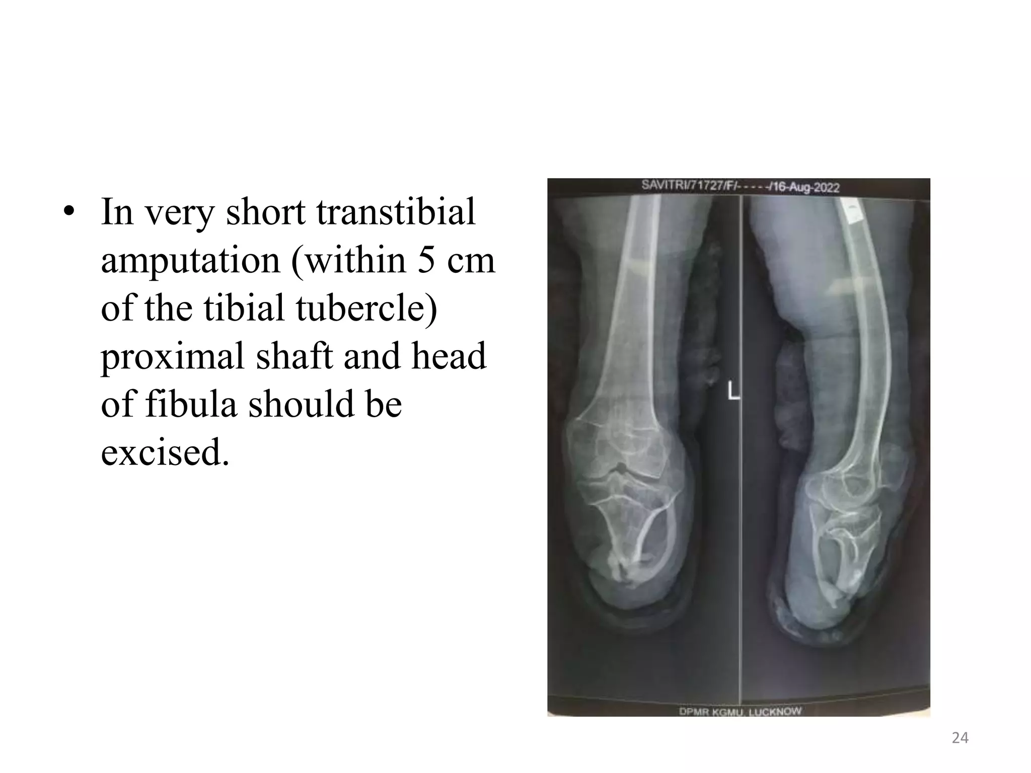 Principles Of Amputation | PPTX