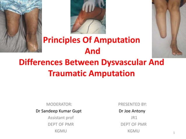 Principles Of Amputation | PPTX