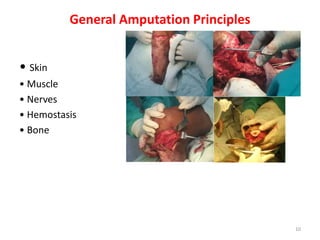 Principles Of Amputation | PPTX