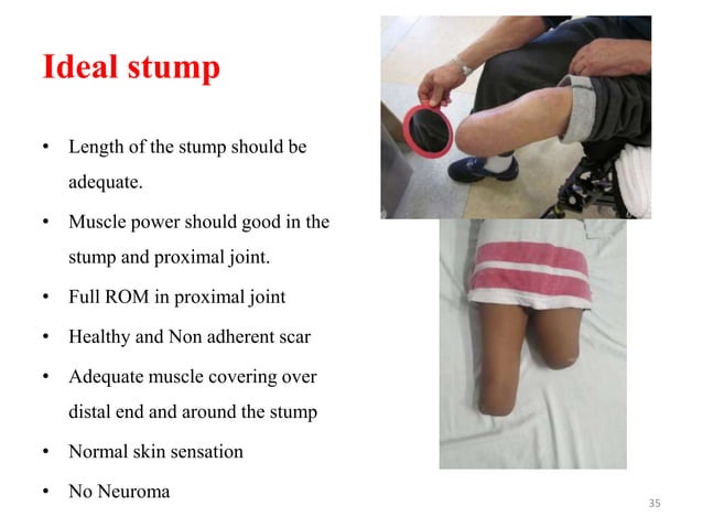 Principles Of Amputation | PPTX