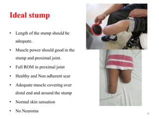 Principles Of Amputation | PPT