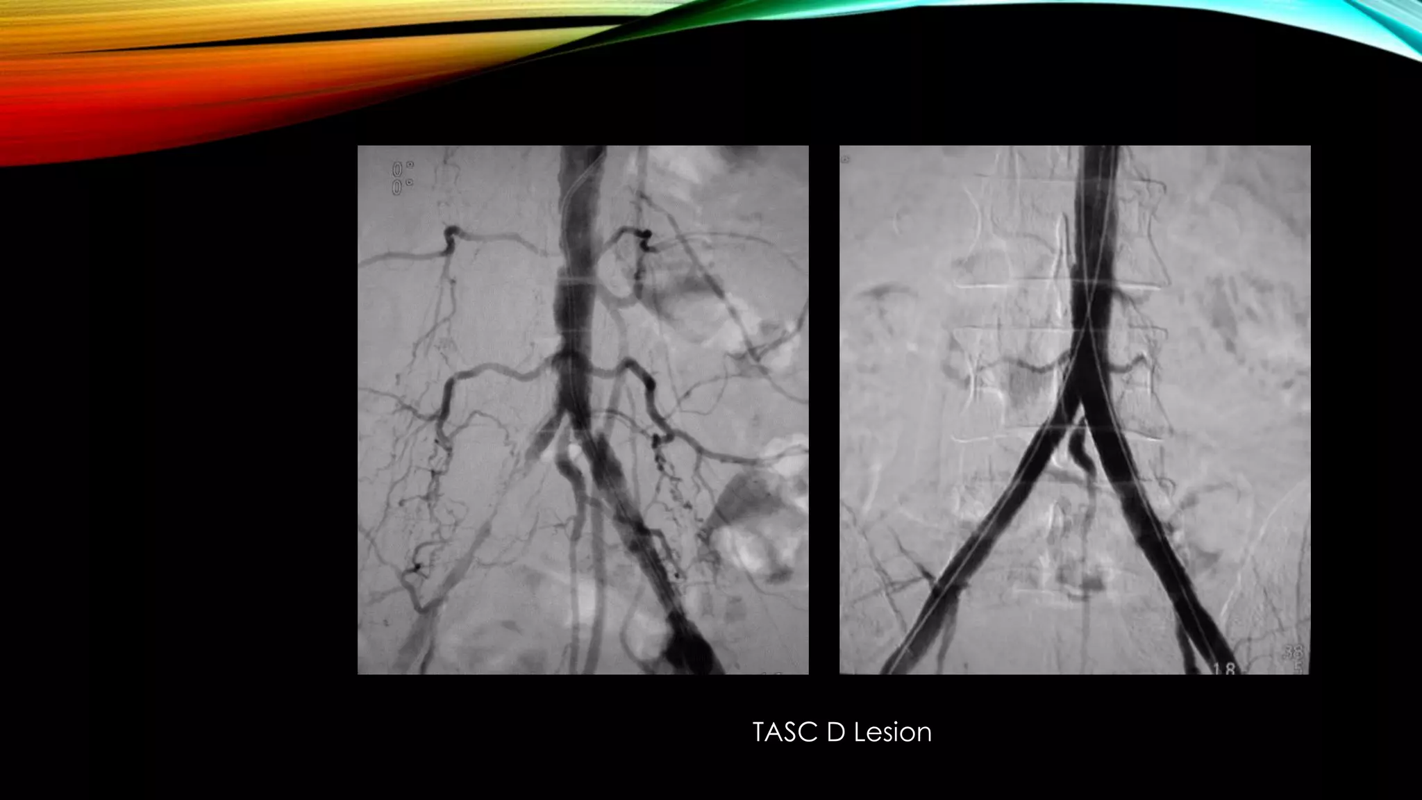 Peripheral Angioplasty / Endovascular Management of PVD - Principles | PPTX