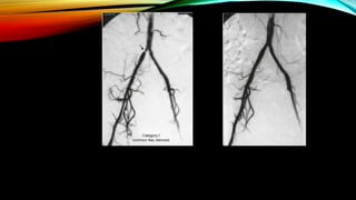 Peripheral Angioplasty / Endovascular Management of PVD - Principles | PPTX