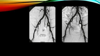 Peripheral Angioplasty / Endovascular Management of PVD - Principles | PPTX