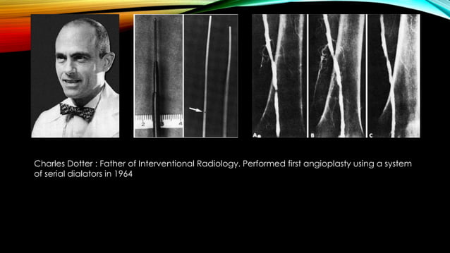 Peripheral Angioplasty / Endovascular Management of PVD - Principles | PPTX
