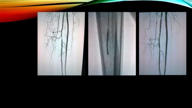 Peripheral Angioplasty / Endovascular Management of PVD - Principles | PPTX