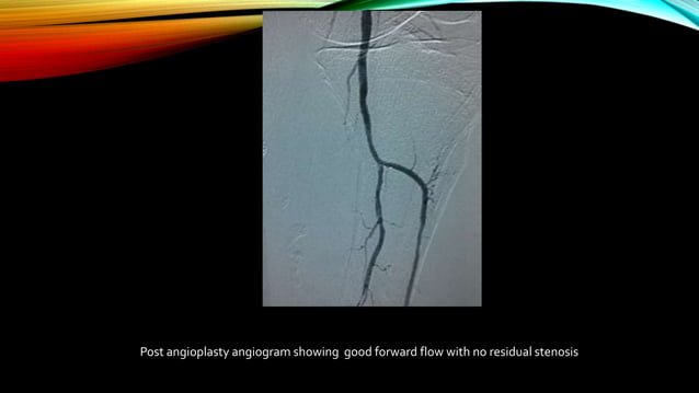 Peripheral Angioplasty / Endovascular Management of PVD - Principles | PPTX