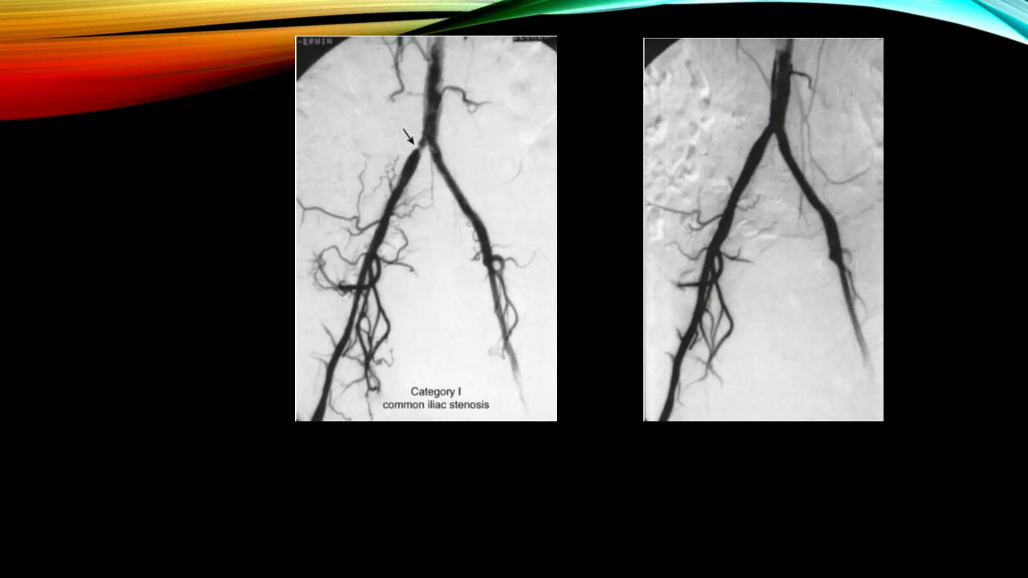 Principles of angioplasty -Endovascular Management of Peripheral ...