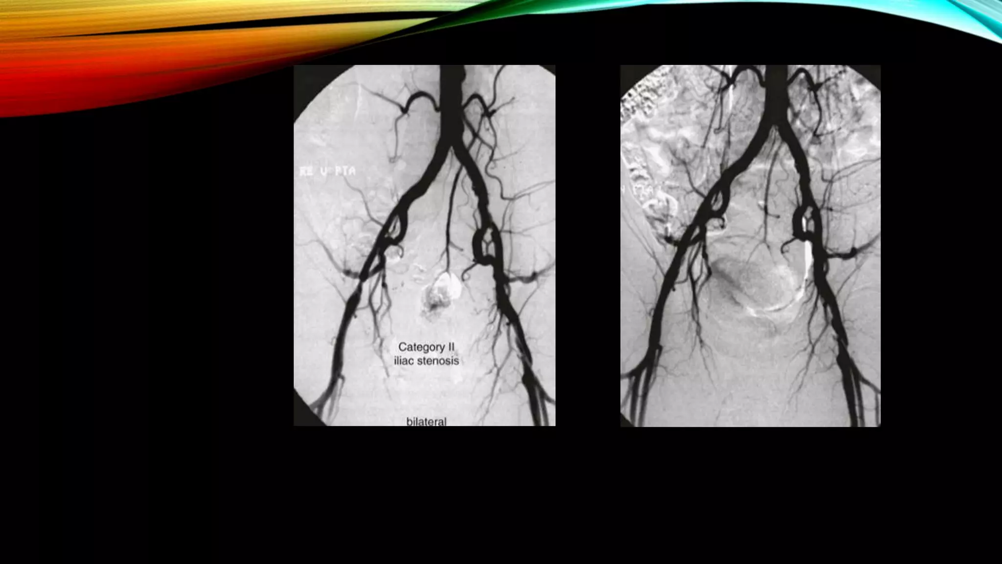 Principles of angioplasty -Endovascular Management of Peripheral ...