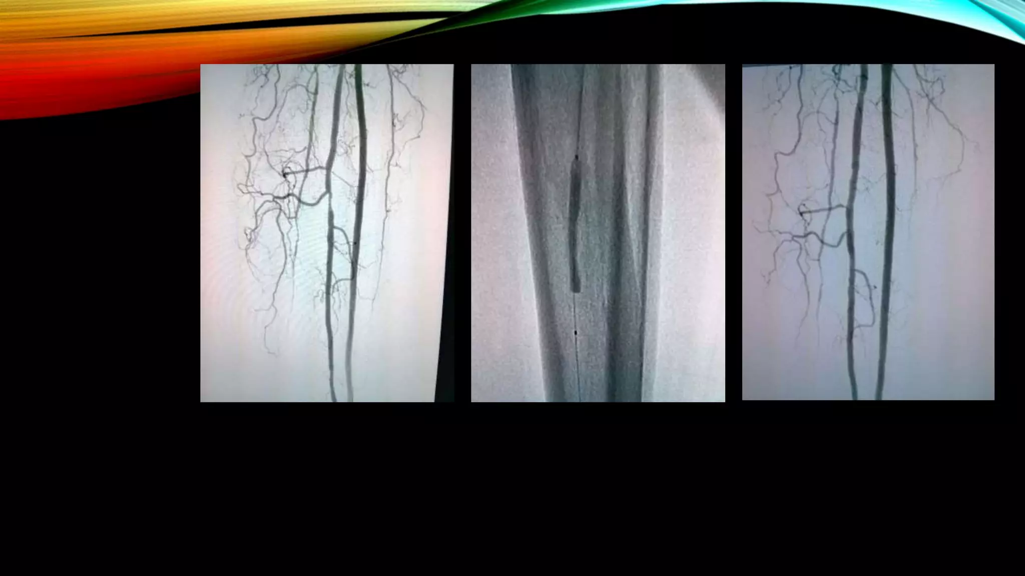 Principles of angioplasty -Endovascular Management of Peripheral ...