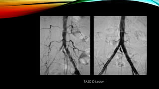 Principles of angioplasty -Endovascular Management of Peripheral ...