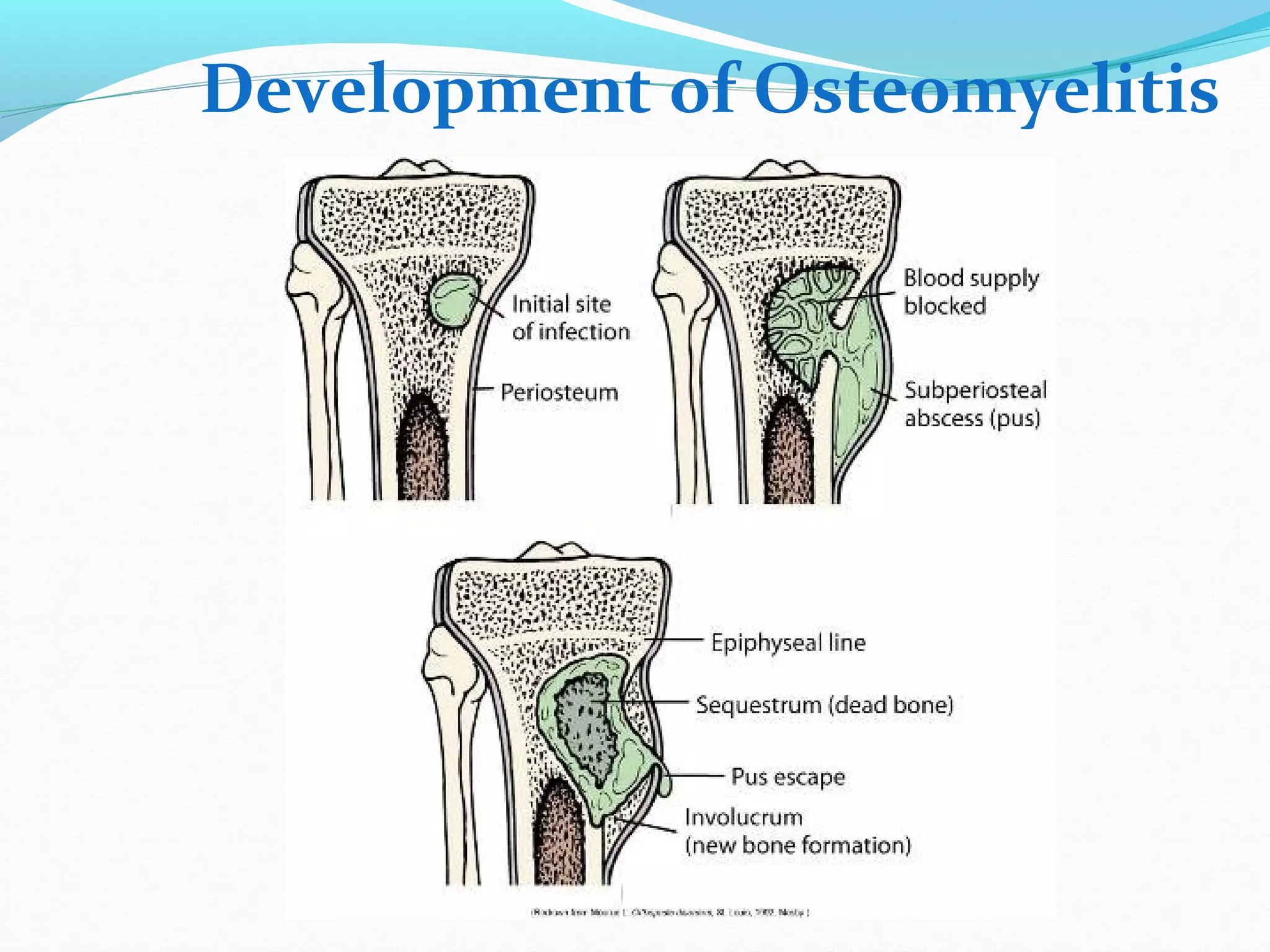 Principles of antibiotic use in management of osteomyelitis | PPT