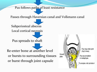Principles of antibiotic use in management of osteomyelitis | PPT