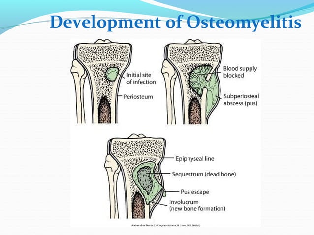 Principles of antibiotic use in management of osteomyelitis | PPT