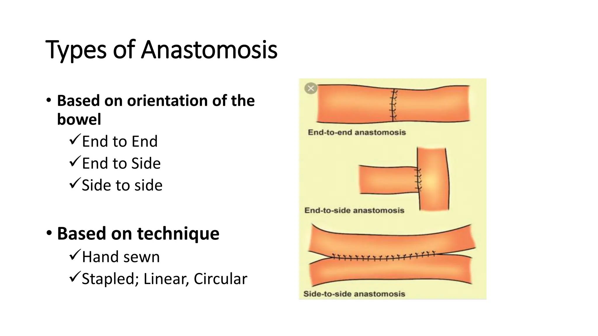 Principles of Bowel Anastomosis (s&l)-1.pptx