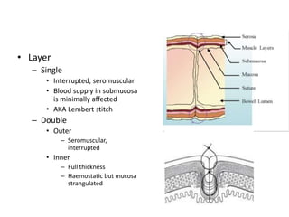 Principles of bowel anastomosis | PPTX