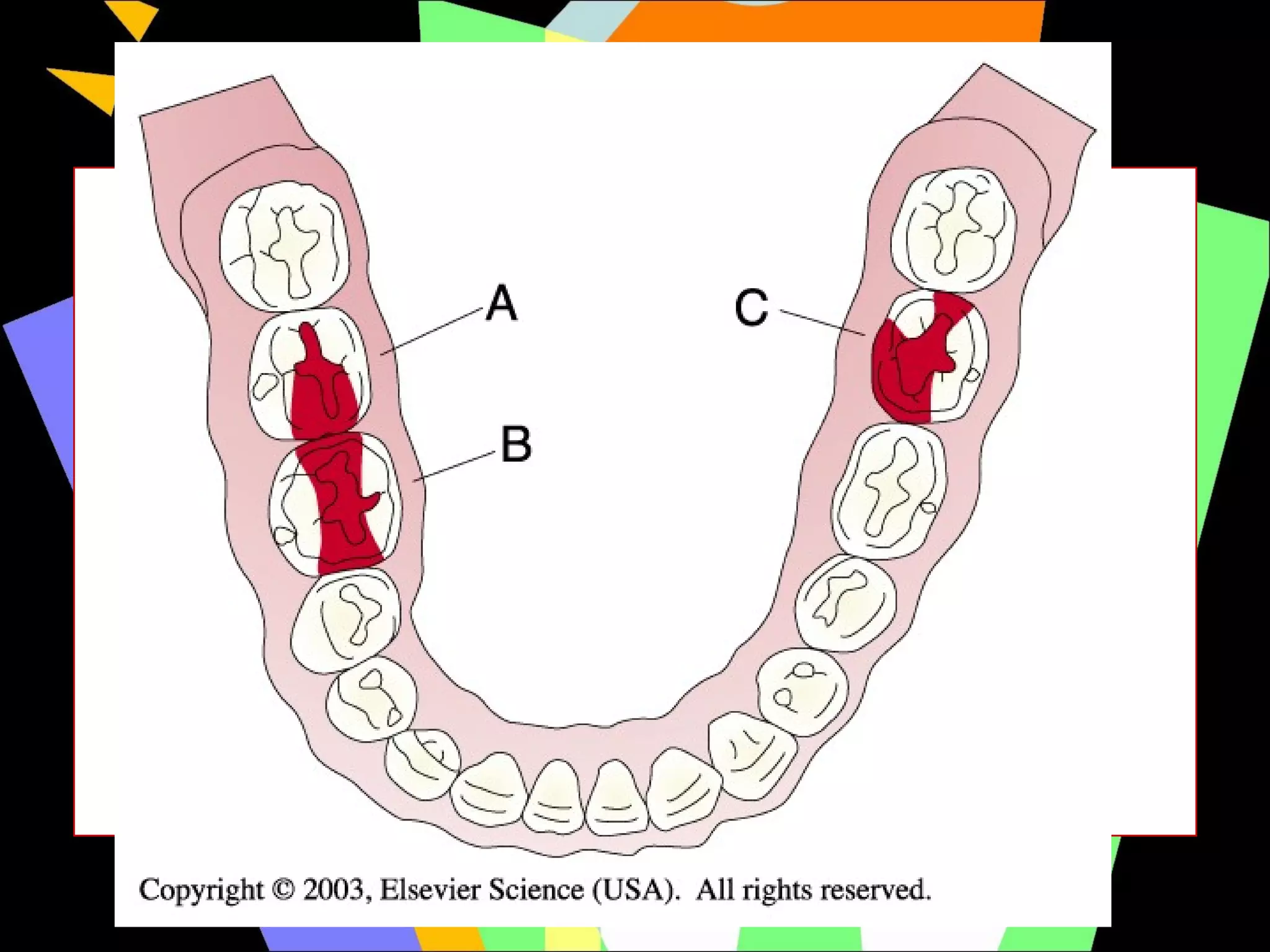 Principles and concepts of cavity preparation | PPT